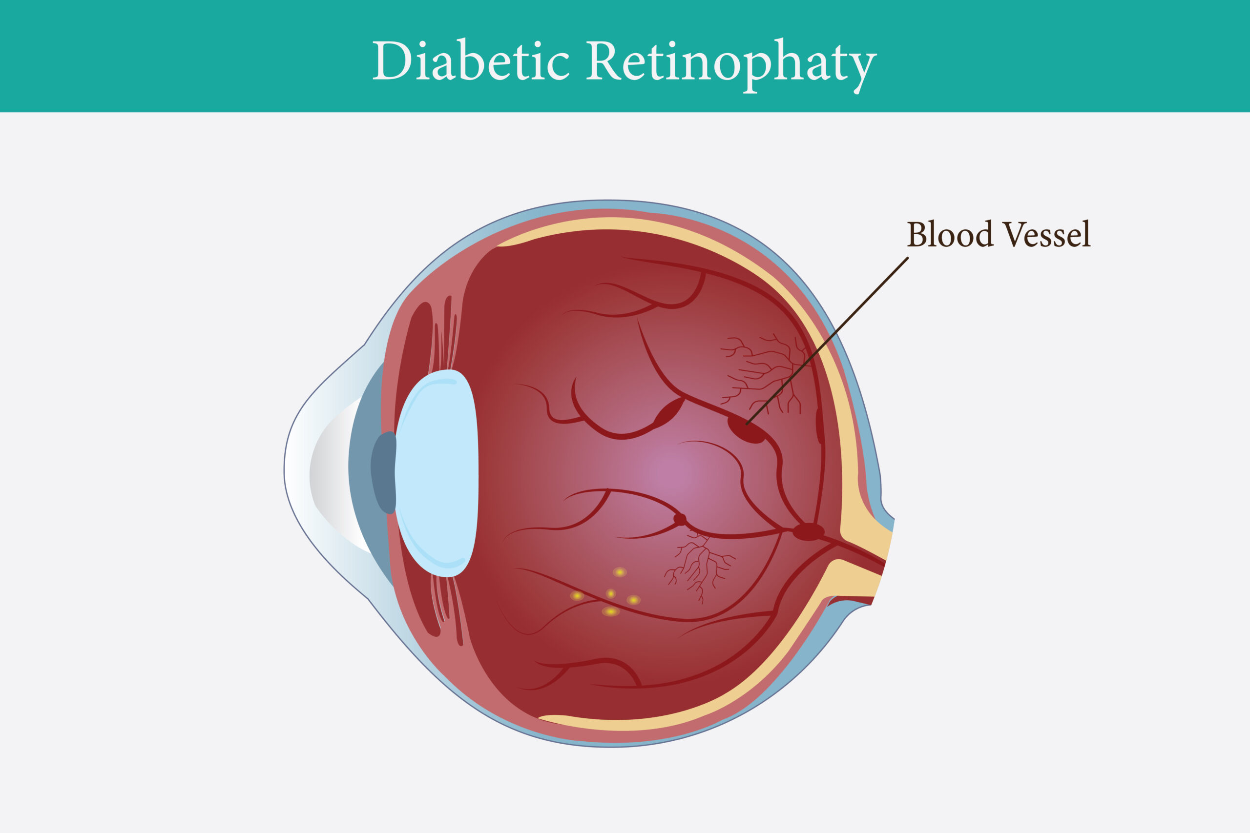 A Closer Look at Diabetic Retinopathy: Causes, Symptoms, and Treatment ...